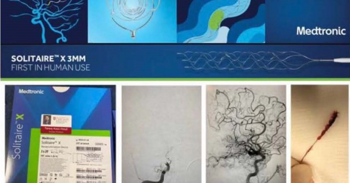 Dr. Tareq Kass-Hout performs the first Solitaire X 3MM procedure on a ...